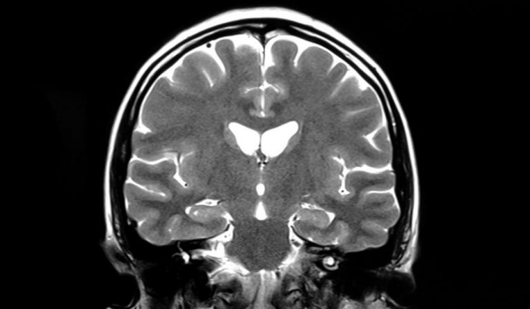 Brain Images Show Effects of Celiac Disease | Celiac Disease Foundation